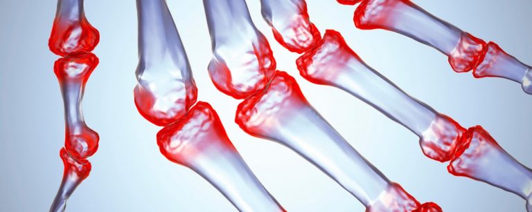 Artrite Reumatoide - Artrite Reumatóide