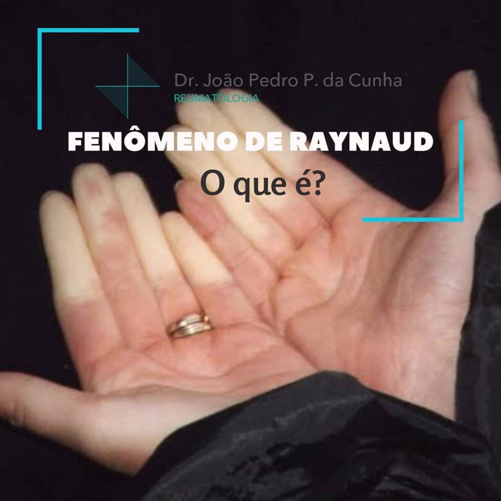 Fenômeno de Raynaud – O que é? - Artrite Reumatóide