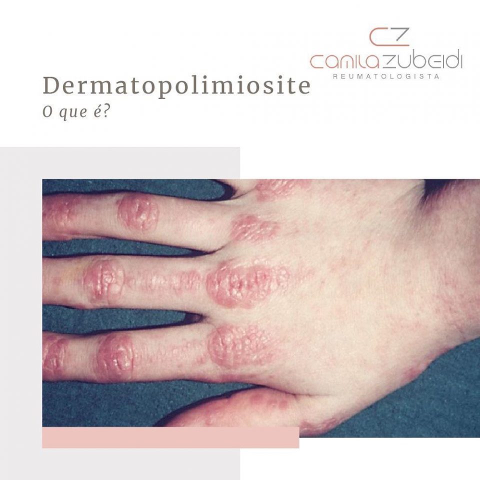 Dermatopolimiosite – O que é? - Artrite Reumatóide