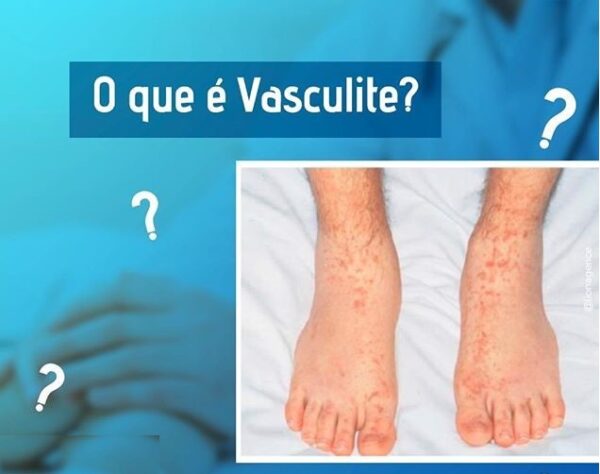 O que é vasculite, como diagnosticar e tratar a inflamação - Artrite ...