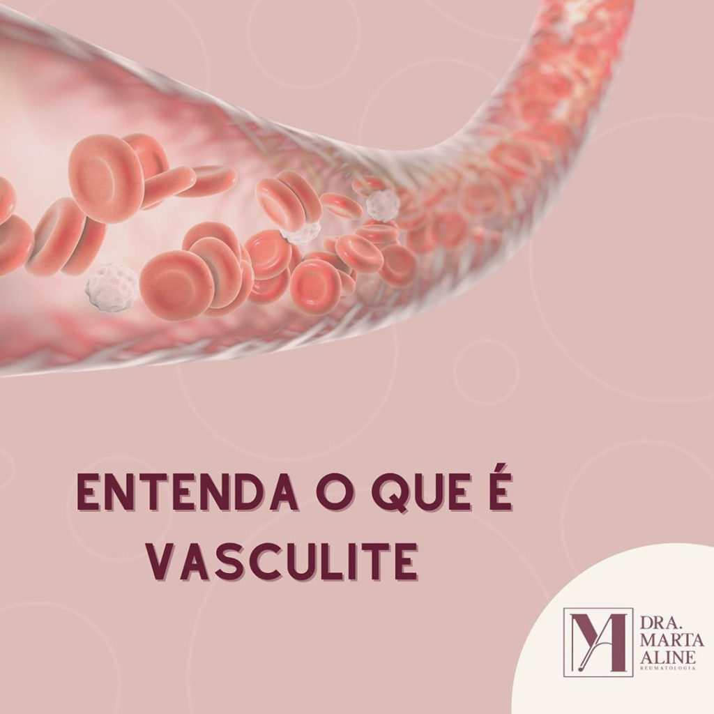 Entenda o que é vasculite - Artrite Reumatóide