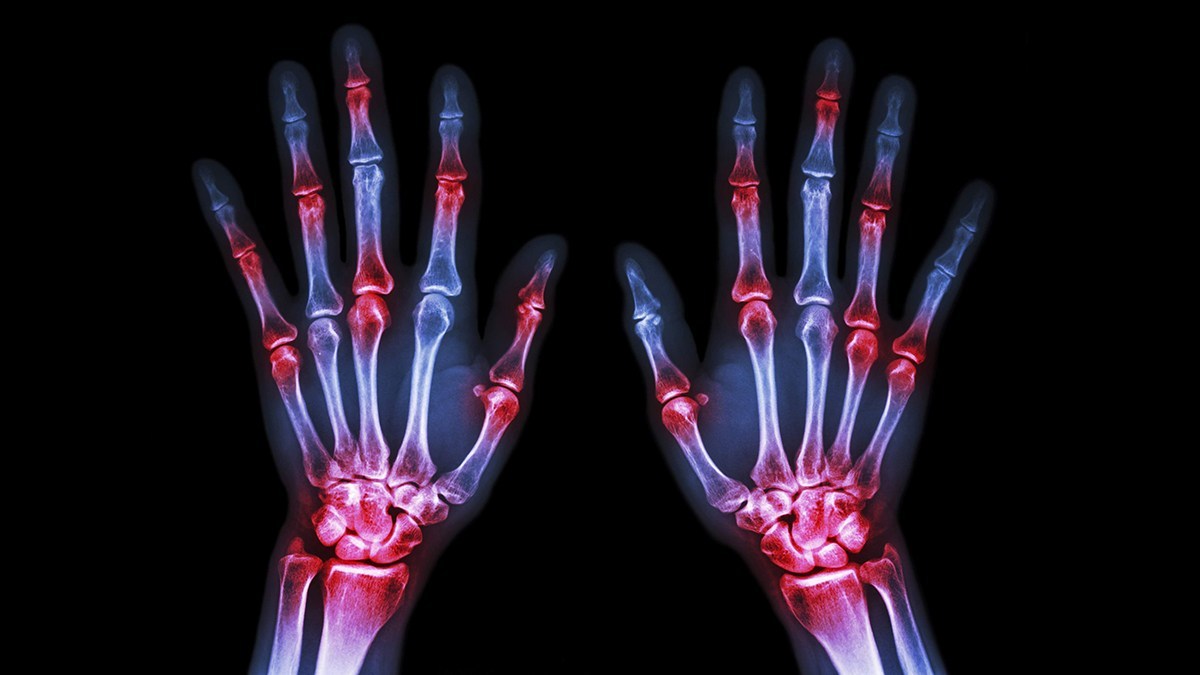 O que é a Artrite Reumatoide? - Artrite Reumatóide