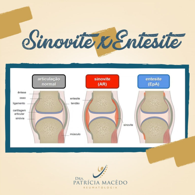 Sinovite X Entesite - Artrite Reumatóide