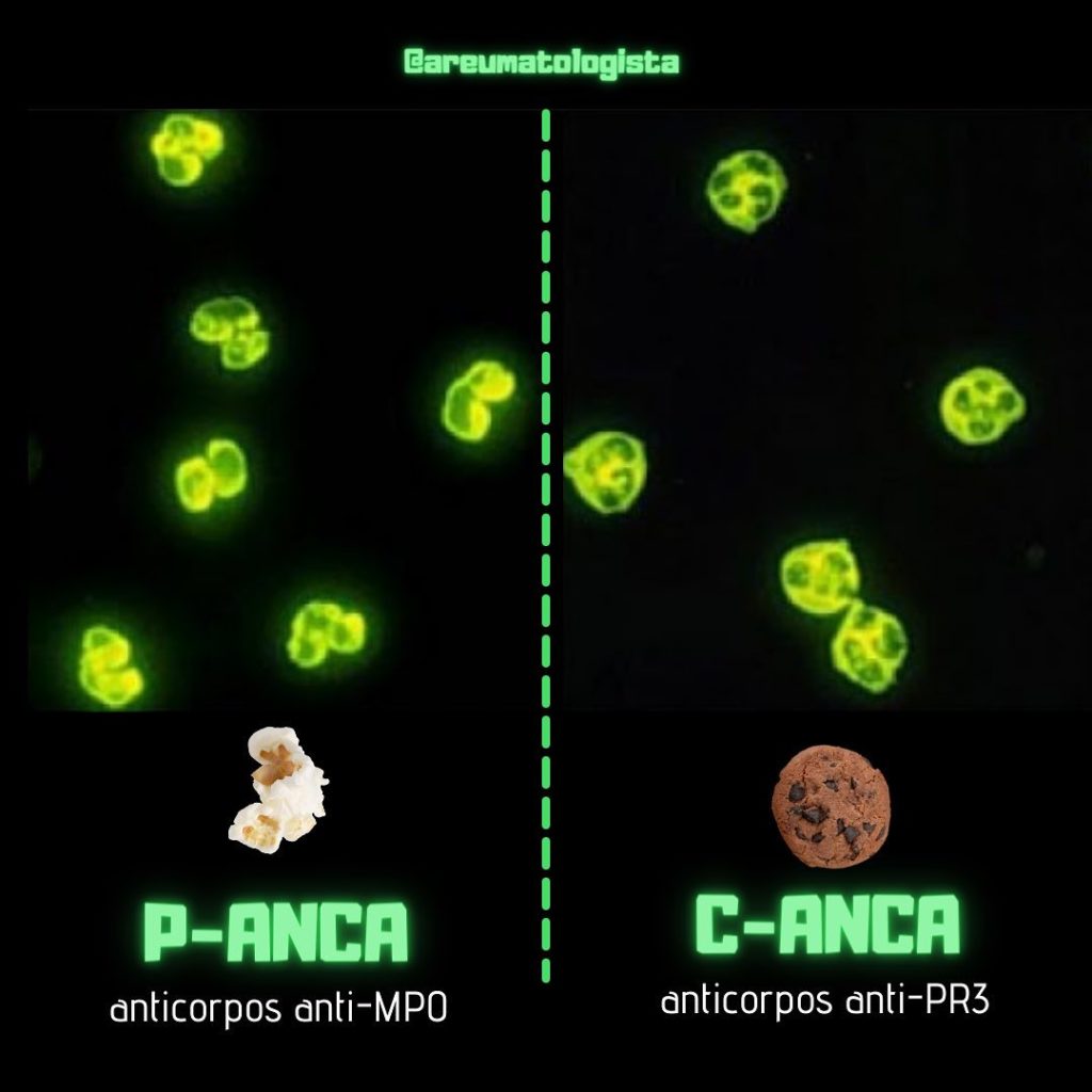Exames diagnósticos: ANCA - Artrite Reumatóide