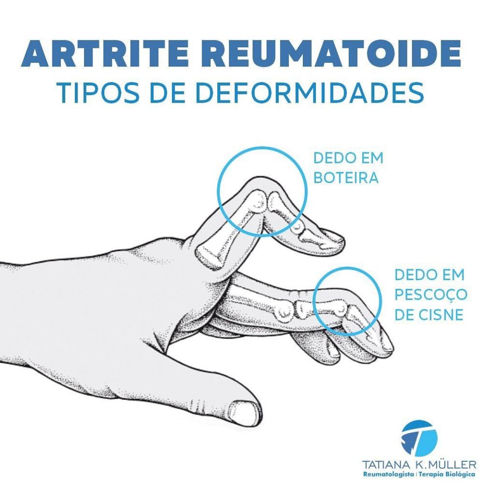 Artrite reumatoide – tipos de deformidades - Artrite Reumatóide