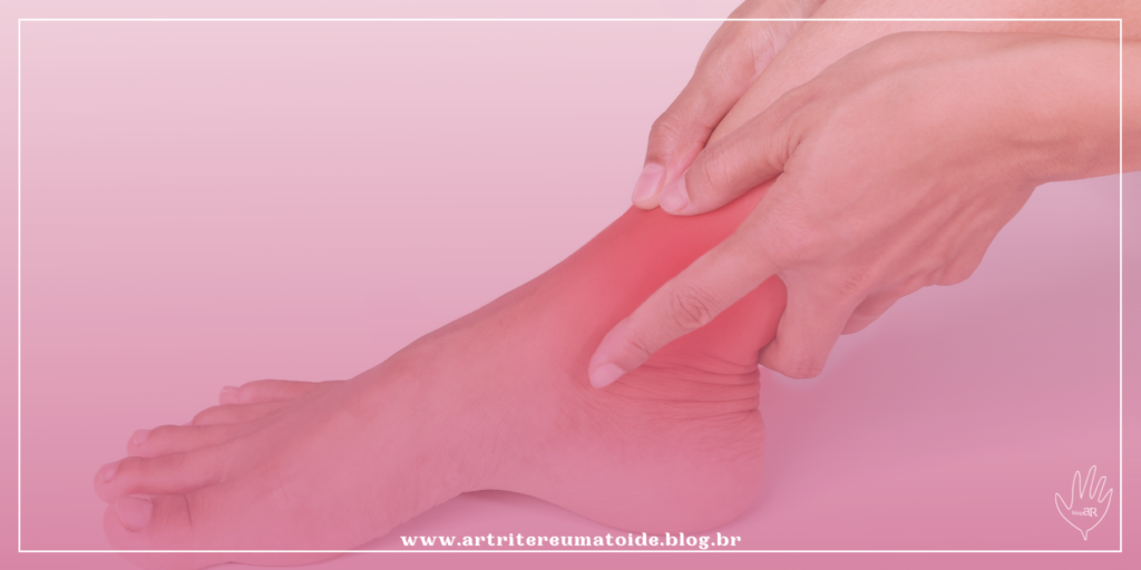 O inchaço no tornozelo é um sinal de doença? - Artrite Reumatóide