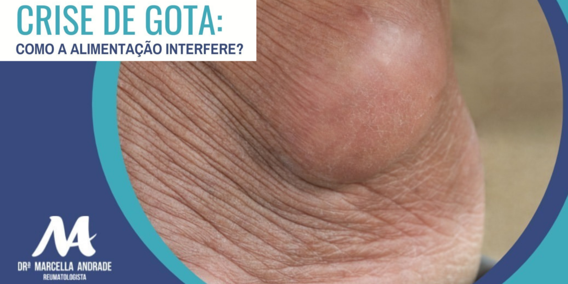 Crise de Gota – Como a alimentação interfere? - Artrite Reumatóide