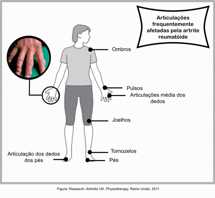 Artrite reumatoide: tudo que você precisa saber - Artrite Reumatóide